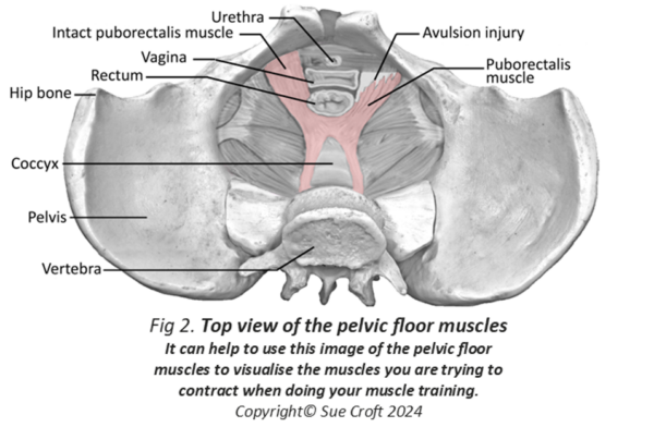 Levator Avulsion: Simply Explained | Pelvic Floor Recovery