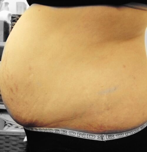 DRAM: Diastasis Of The Rectus Abdominus Muscles | Pelvic Floor Recovery