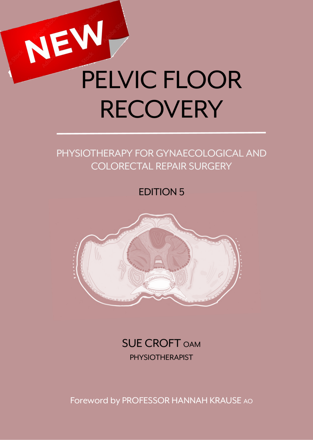 Levator Avulsion: Simply Explained | Pelvic Floor Recovery